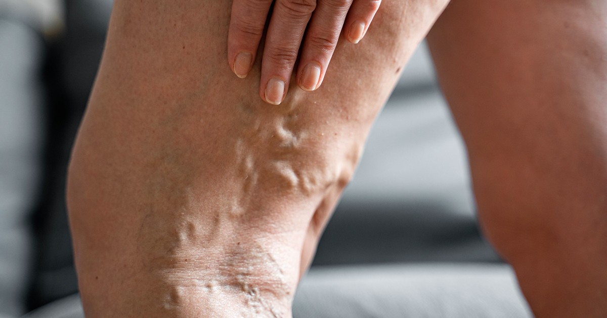 Vene Varicose Rimedi ed Esercizi per anziani